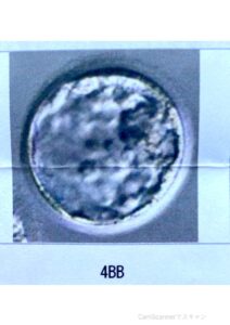 ブログ・4bb胚盤胞で妊娠できた？ 移植周期⑥ - 不妊治療のステップアップ体験記｜夫婦で支え合った基礎体温管理と治療の全記録